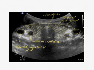 [Sonoanatomy] 氣管 Trachea – POCUS Academy