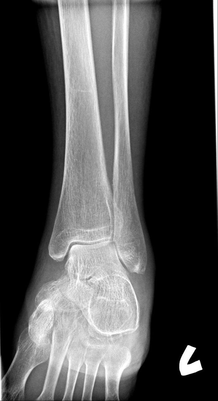 Left ankle sprain – POCUS Academy