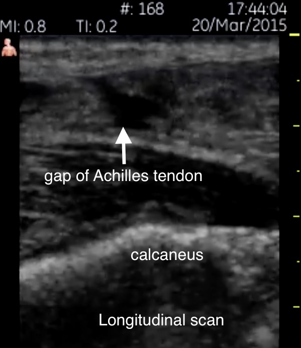 Achilles tendon rupture – POCUS Academy