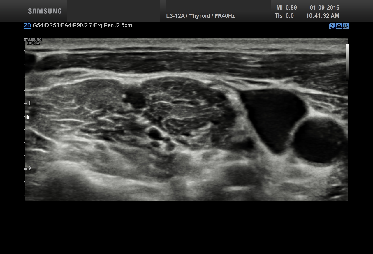 Upper extremity nerve block (I) – POCUS Academy