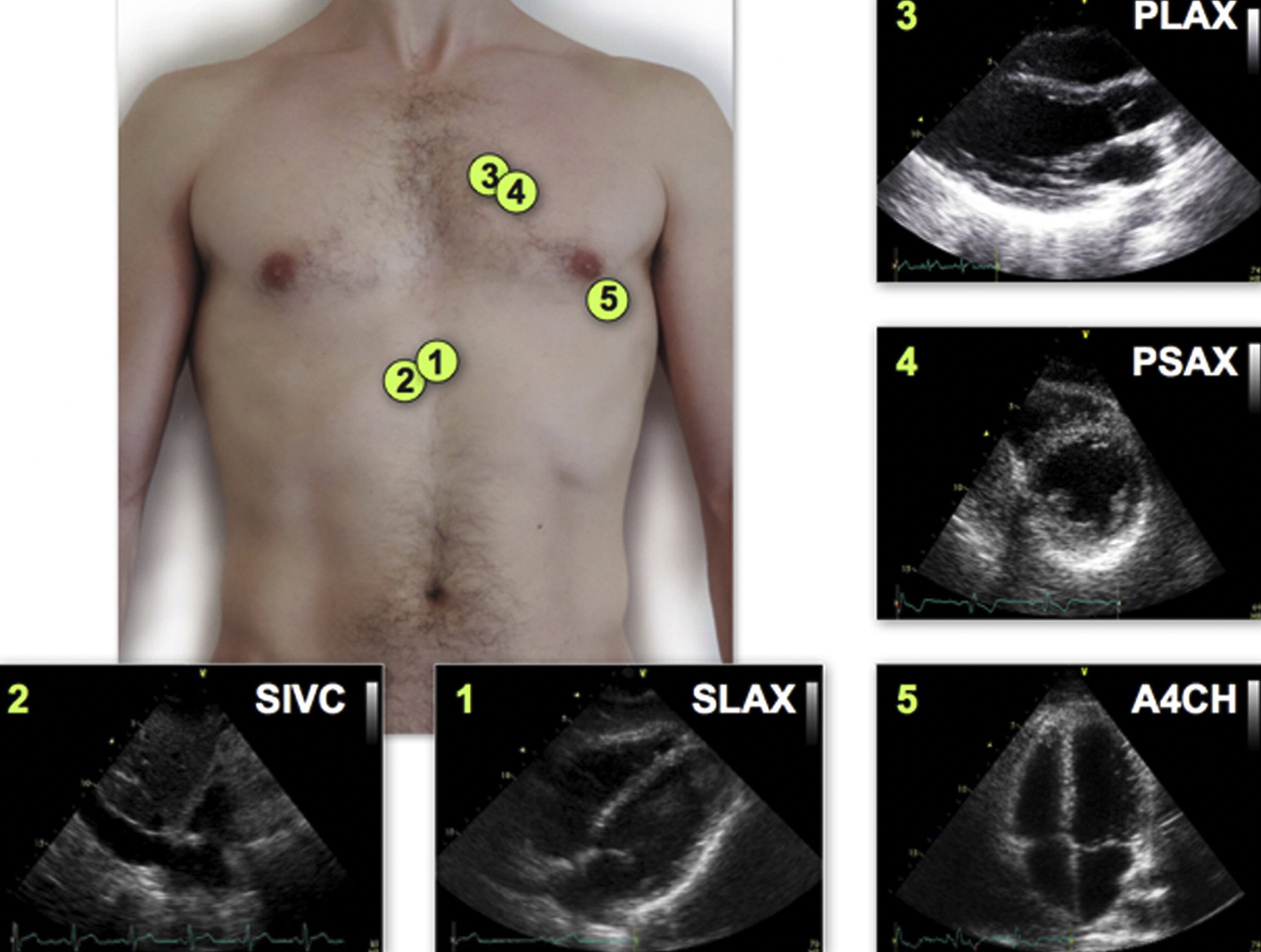 雙和急診超音波教學-Basic Cardiac Echo – POCUS Academy