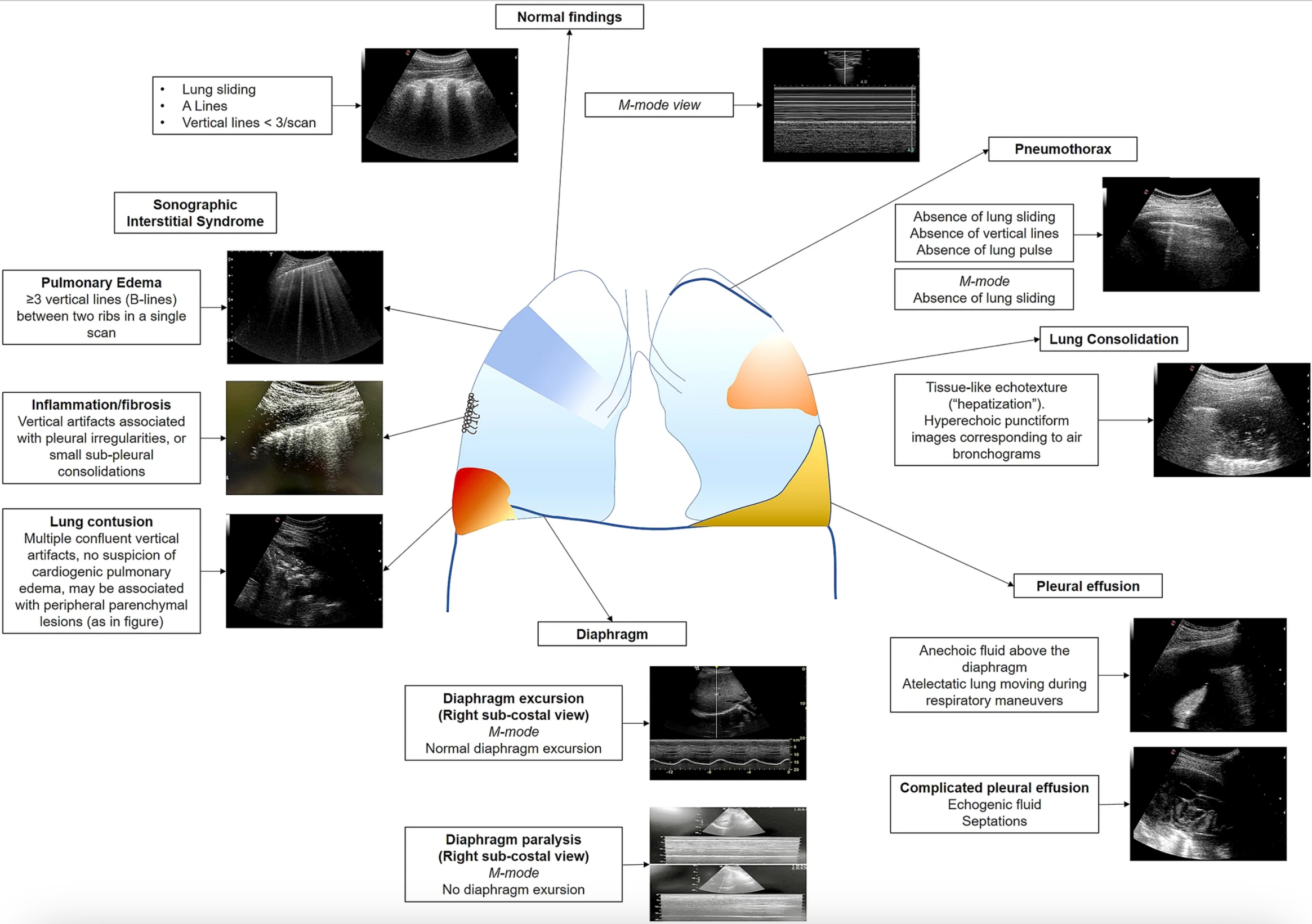 雙和急診超音波教學-Lung US & BLUE protocol – POCUS Academy