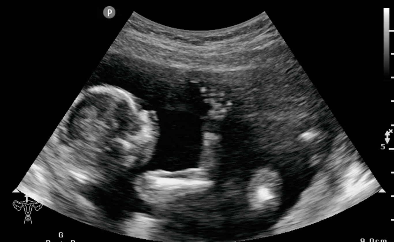 Early pregnancy 16wks – POCUS Academy