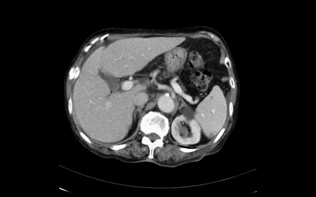 Volvulus – POCUS Academy