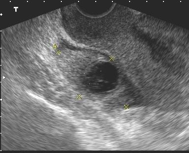 Ectopic pregnancy – POCUS Academy