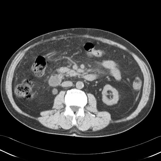 Echogenic fat in abdominal POCUS – POCUS Academy