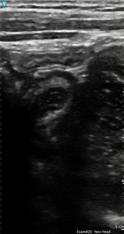 Appendicitis – POCUS Academy