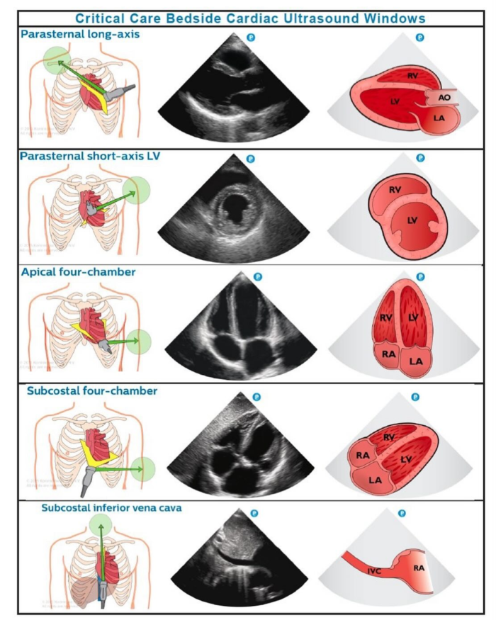 Basic cardiac echo windows (EMNote) – POCUS Academy